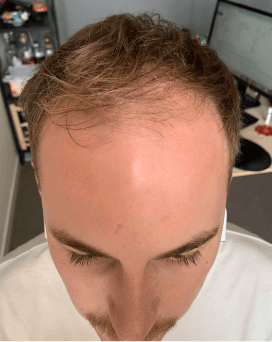 Mosh vs Pilot: Hair Loss Treatments Compared | Mosh